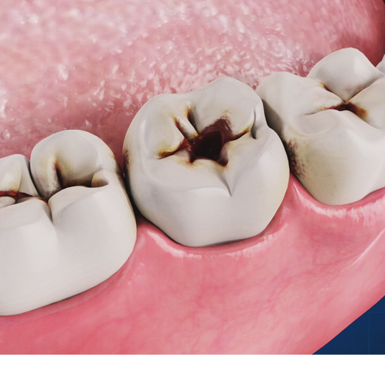 Cabut Gigi Atau Tambal Gigi? Pilihan Mana Yang Paling Baik? - pondokgigi.com